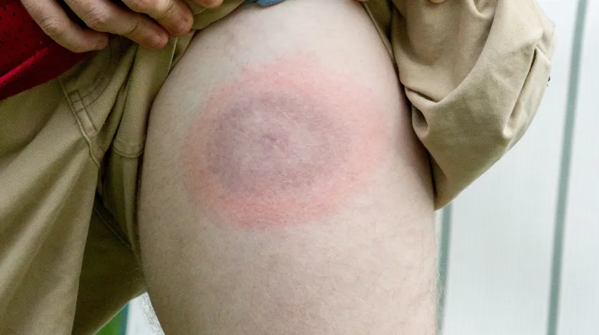 Tick Talk: Six Things to Know About Lyme Disease | South Shore Health